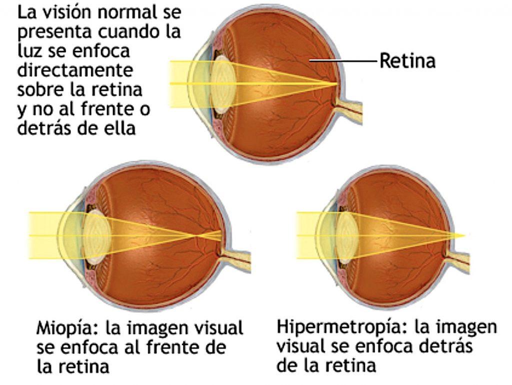 Miopía Hipermetropía Astigmatismo Y Presbicia Insadof