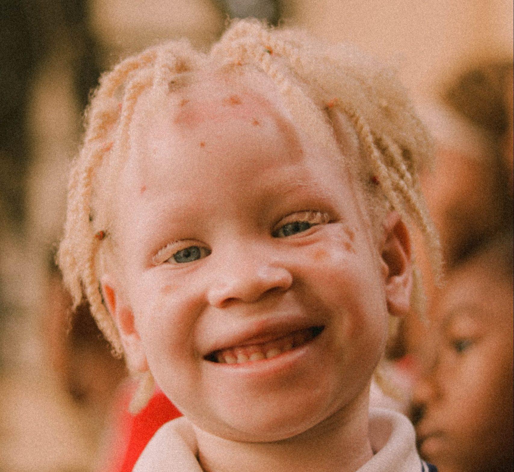 Albinismo y visión | Insadof