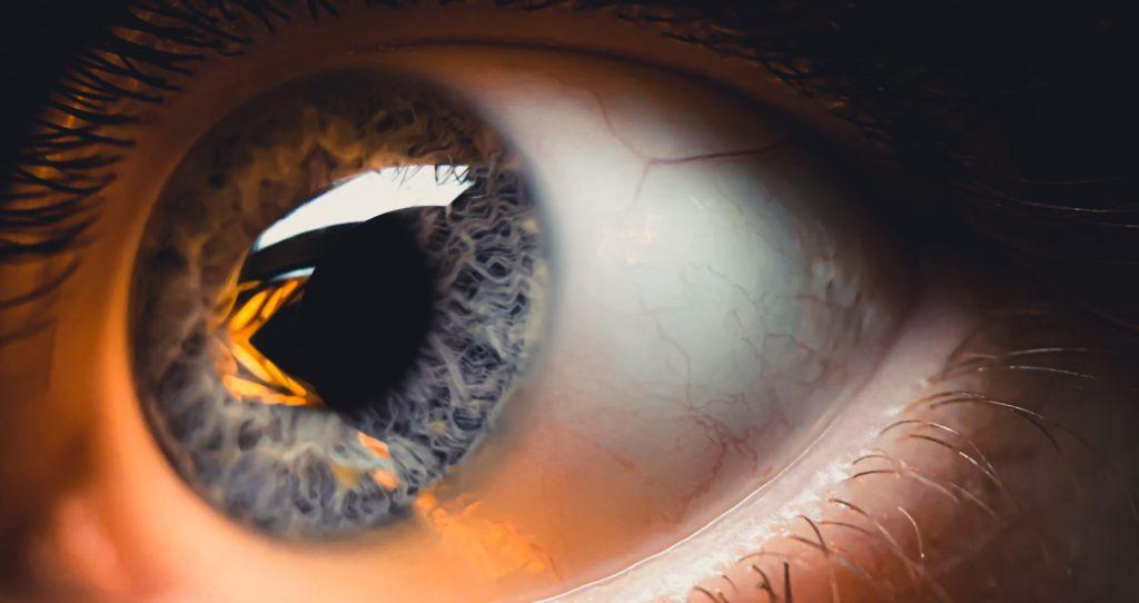 Córnea Gruesa | Insadof